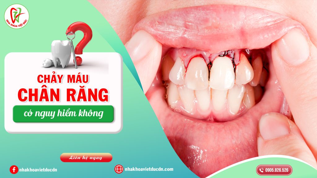 CHẢY MÁU CHÂN RĂNG CÓ NGUY HIỂM KHÔNG? - Nha Khoa Việt Đức